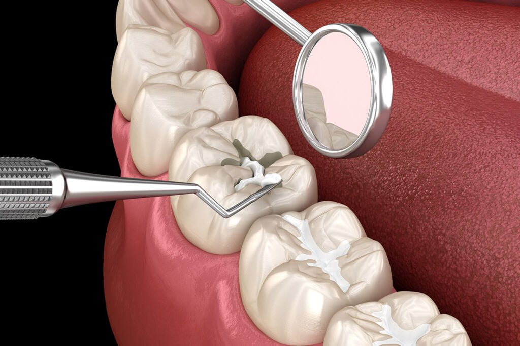 Dental Onlay | Onlay Near Me | KL Dental